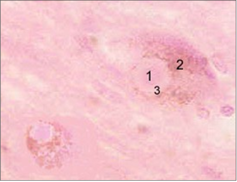 Lewy body dementia - Neuromedia