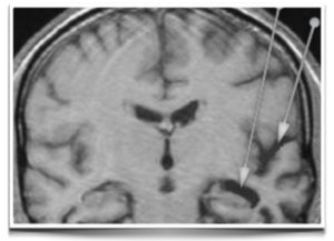 Semantic dementia - Neuromedia